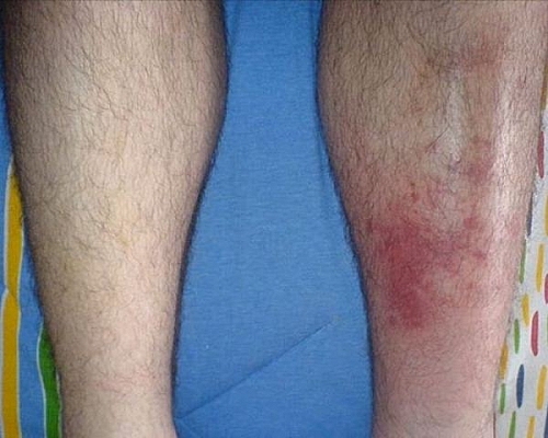 Cellulitis Treatment Symptoms Signs Causes And Complications Cellulitis Treatment Symptoms Signs Causes And Complications
